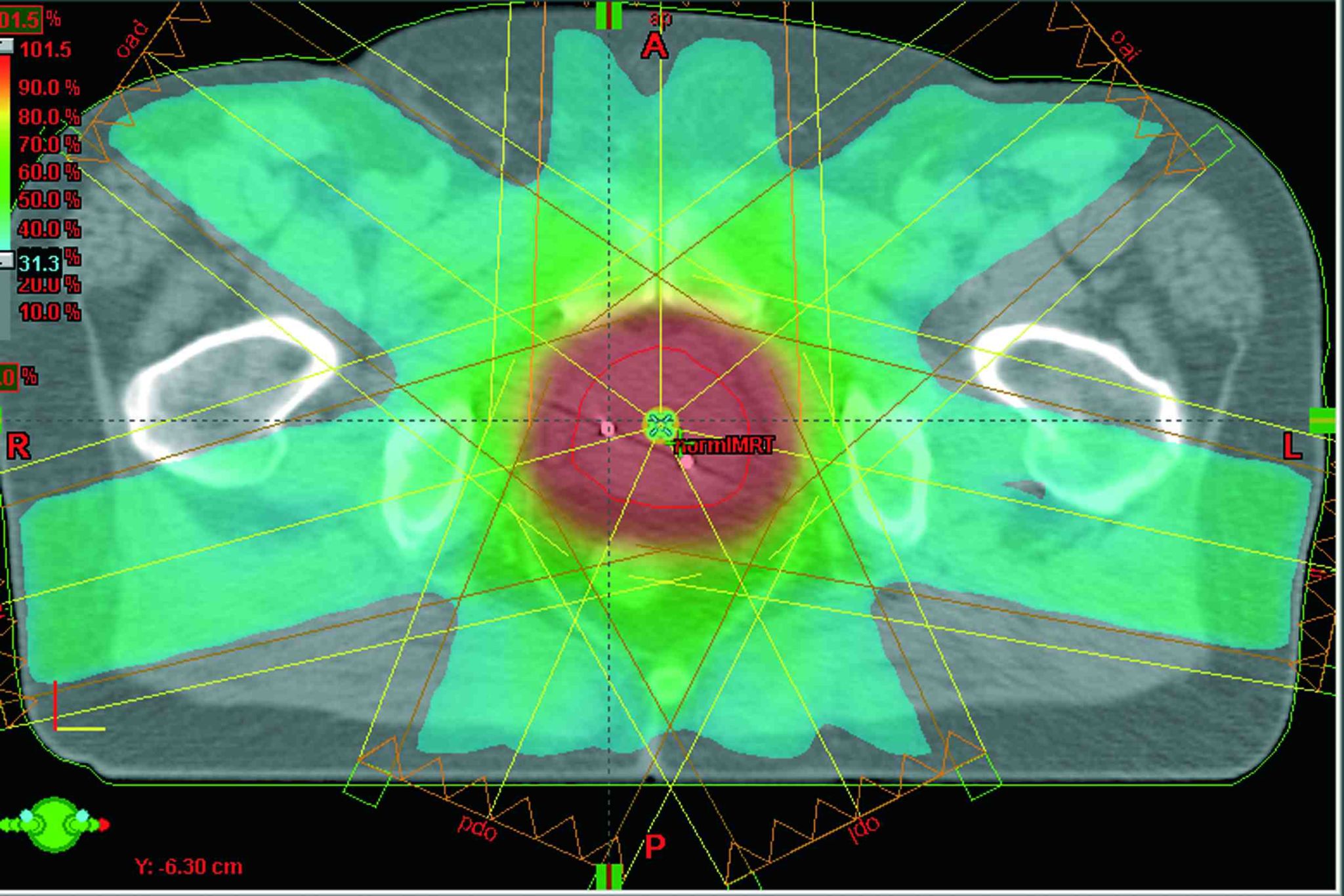 Radioterapia guiada por imagen | Fundacion TEDECA